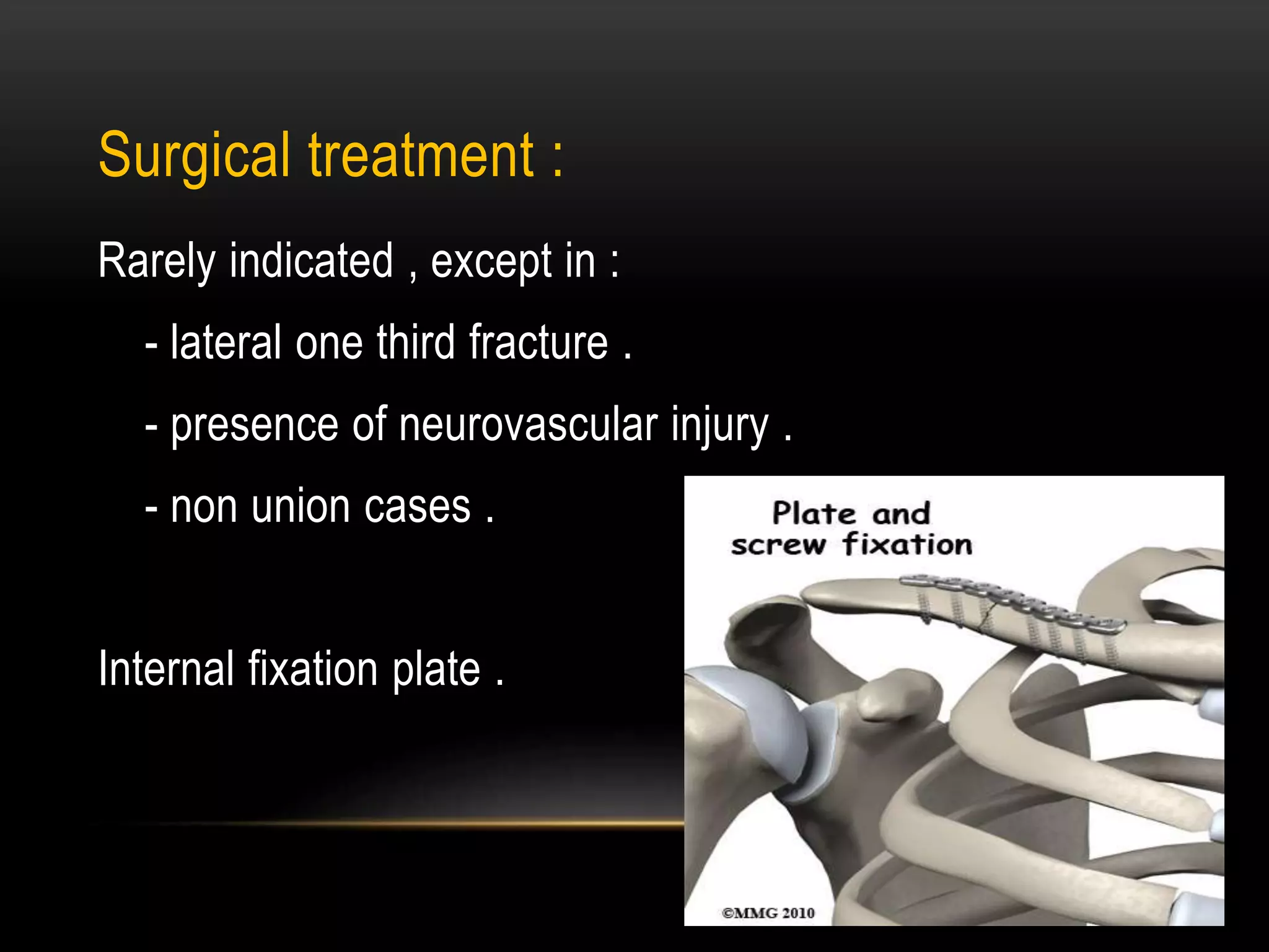 Clavicle fracture | PPTX