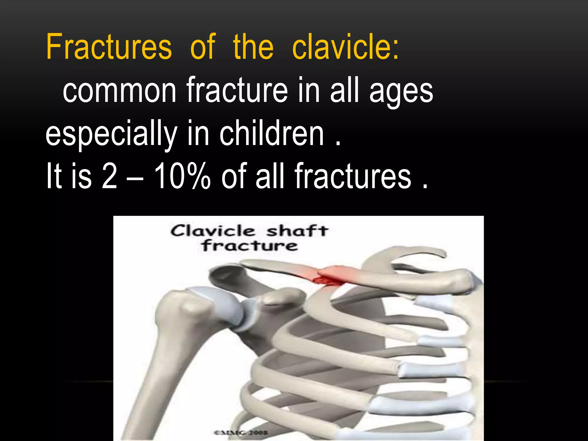 Clavicle fracture | PPTX