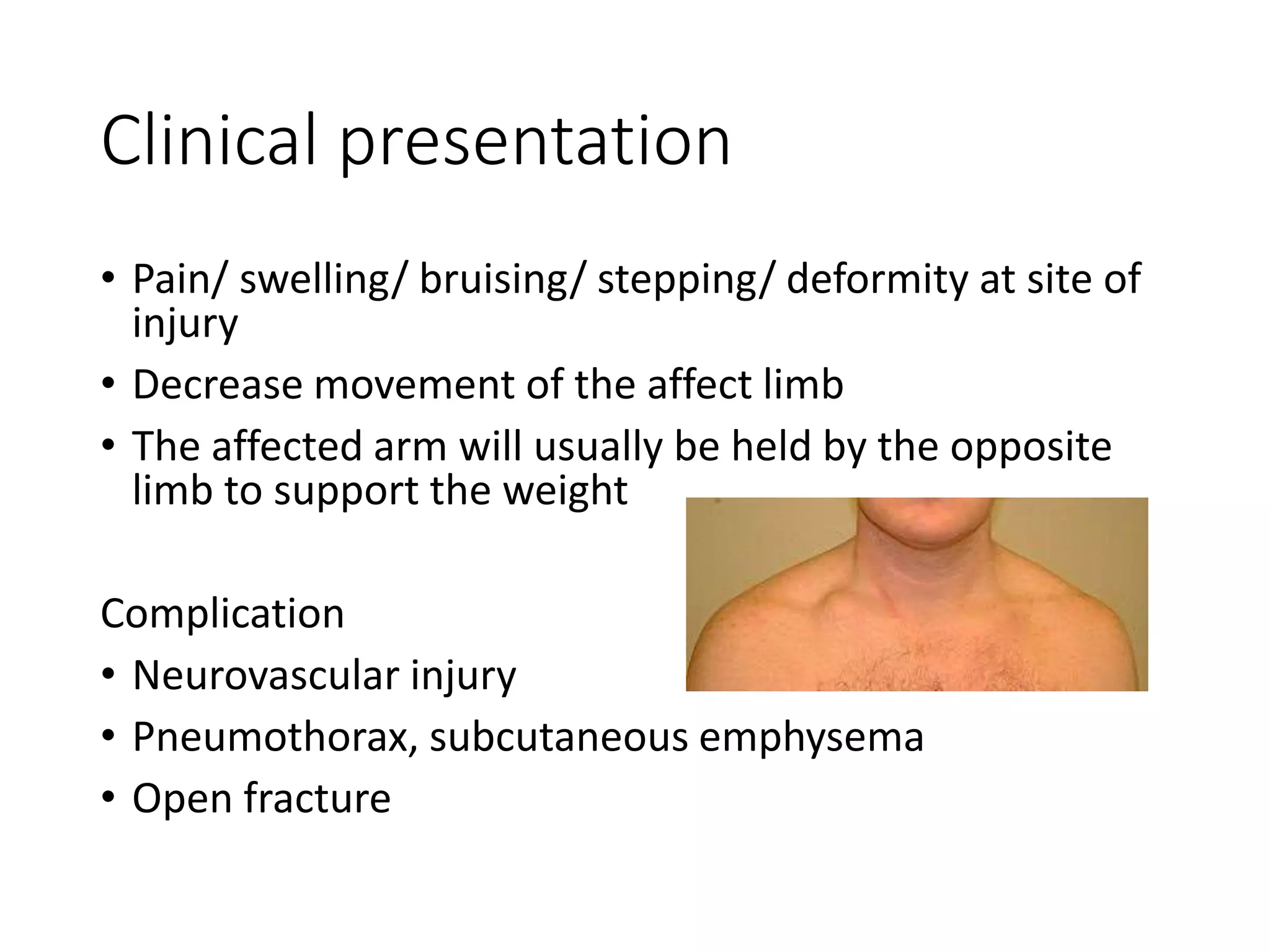 Clavicle fracture | PPTX