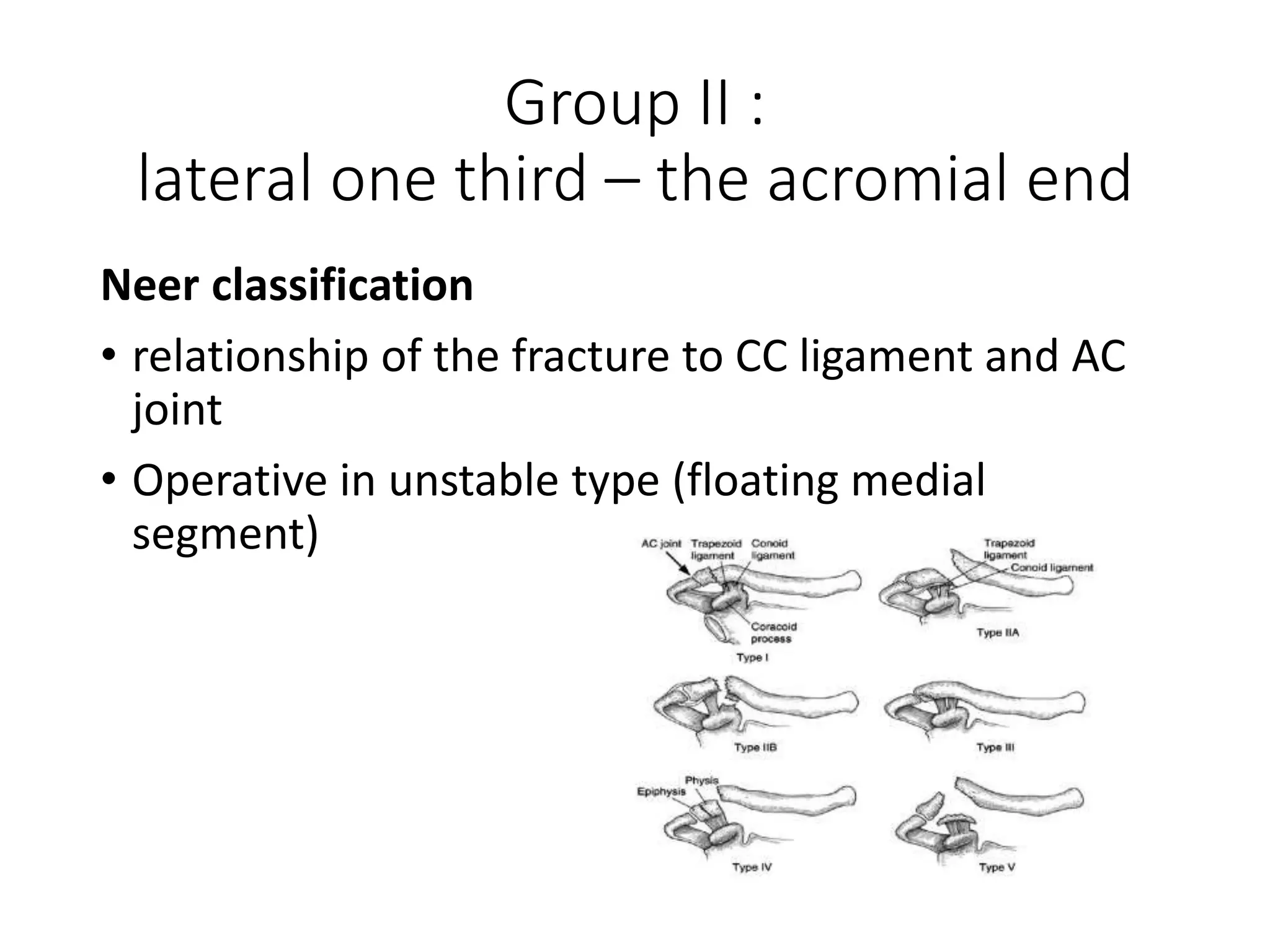 Clavicle fracture | PPTX