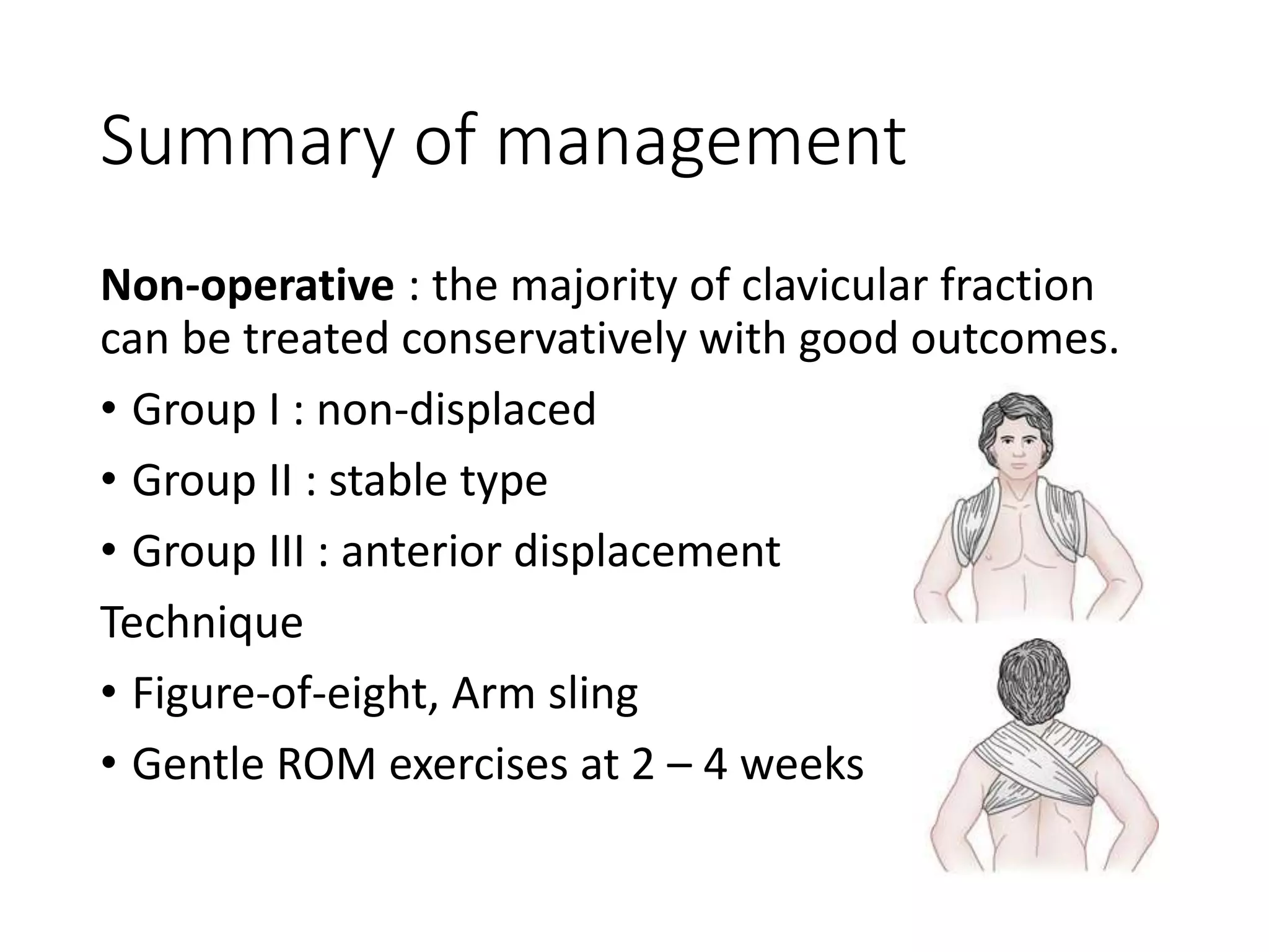 Clavicle fracture | PPTX
