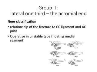 Clavicle fracture | PPTX