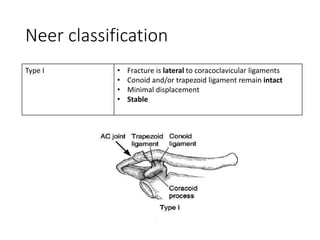 Clavicle fracture | PPTX