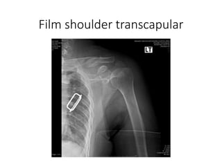 Clavicle fracture | PPTX