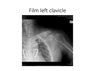 Clavicle fracture | PPTX