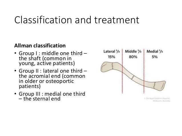 Clavicle Fracture Classification Upper Limb Injuries | Emergency Care