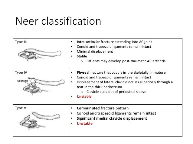 Clavicle Fracture Classification Upper Limb Injuries | Emergency Care