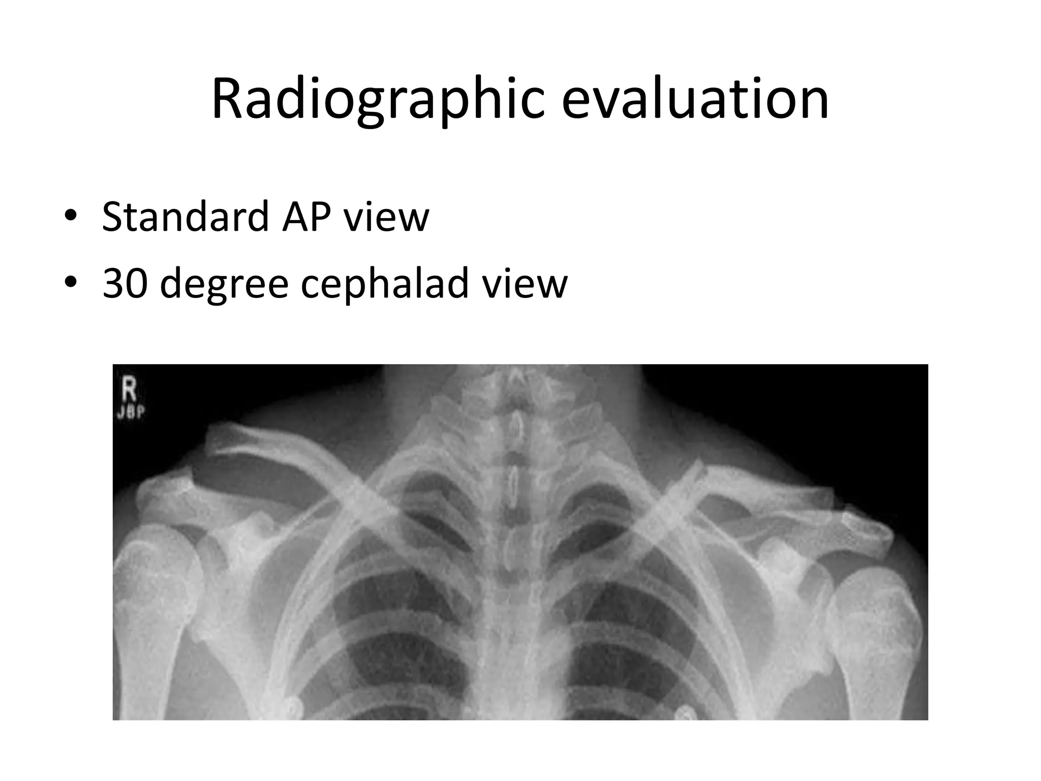 Clavicle fracture & injuries around shoulder | PPTX
