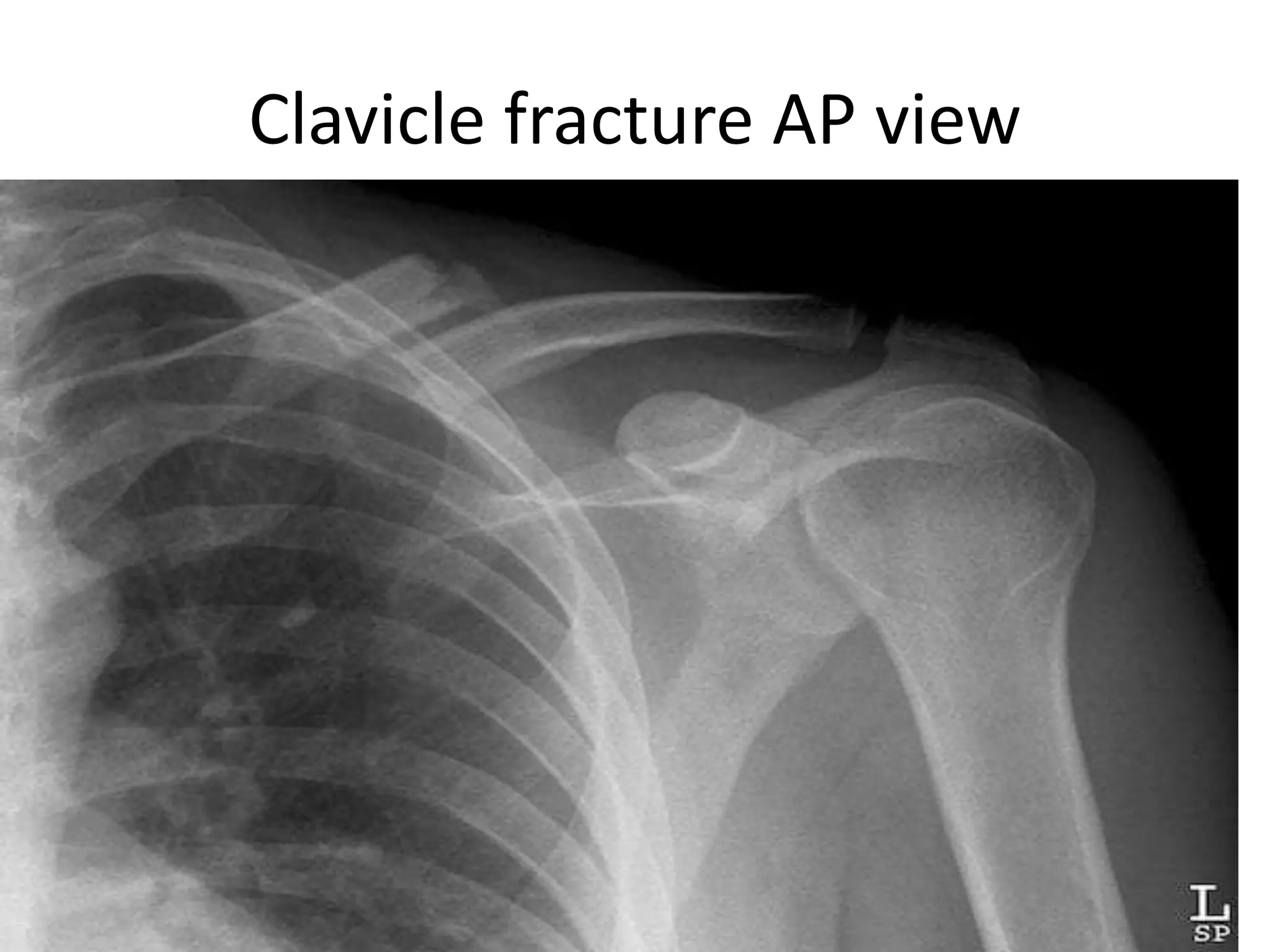 Clavicle fracture & injuries around shoulder | PPTX