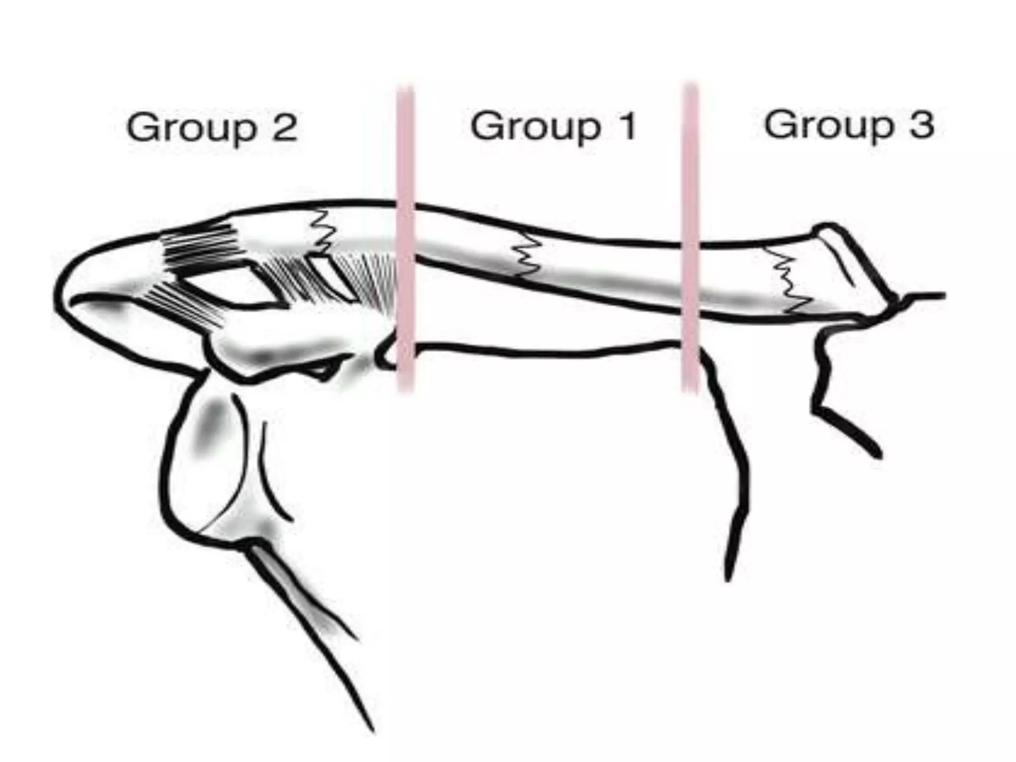 Clavicle fracture & injuries around shoulder | PPTX