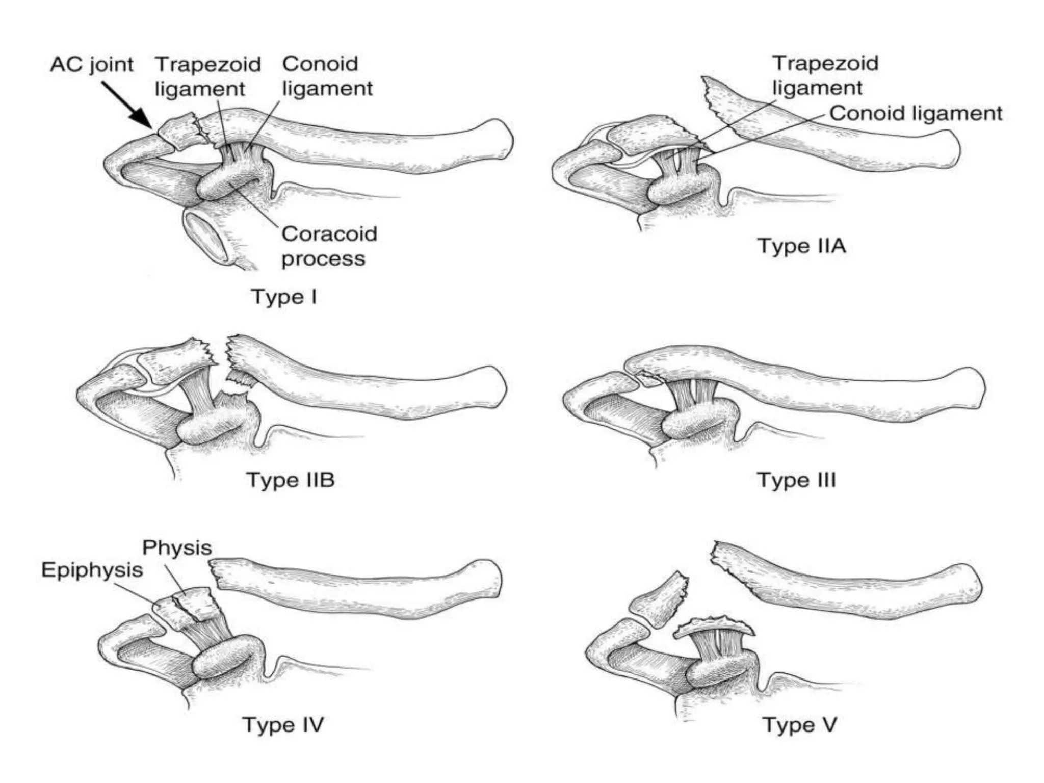 Clavicle fracture & injuries around shoulder | PPTX