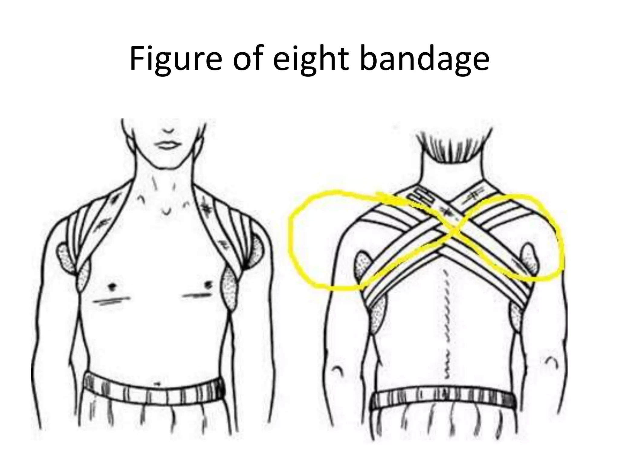 Clavicle fracture & injuries around shoulder | PPTX