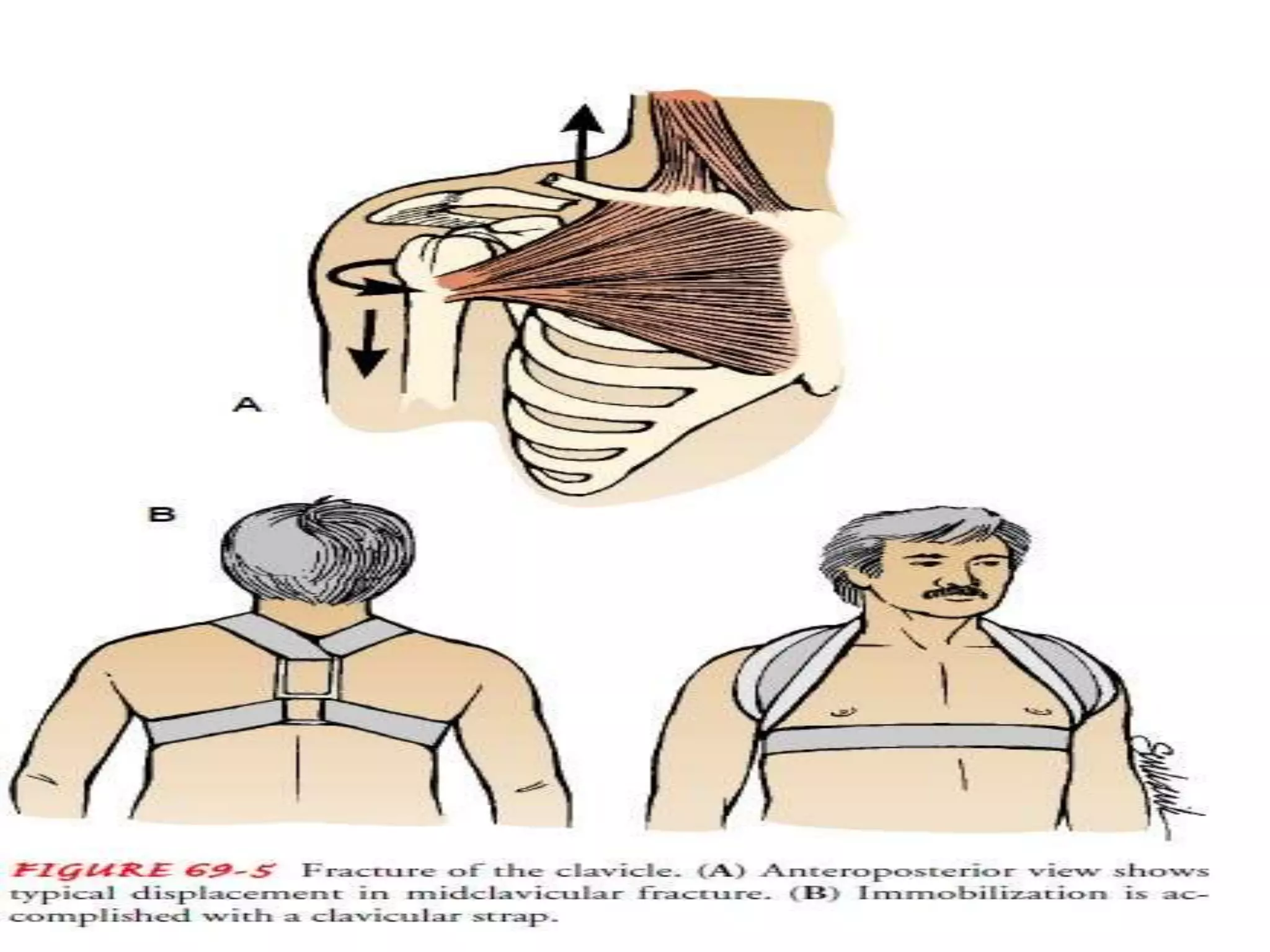 Clavicle fracture & injuries around shoulder | PPTX