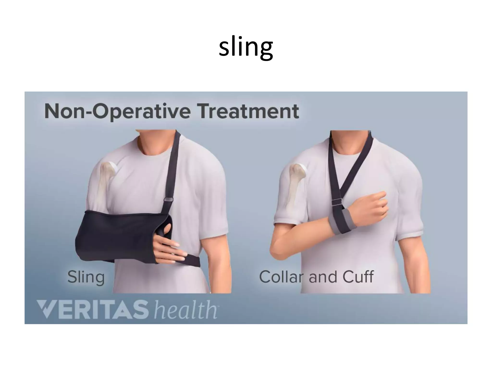 Clavicle fracture & injuries around shoulder | PPTX