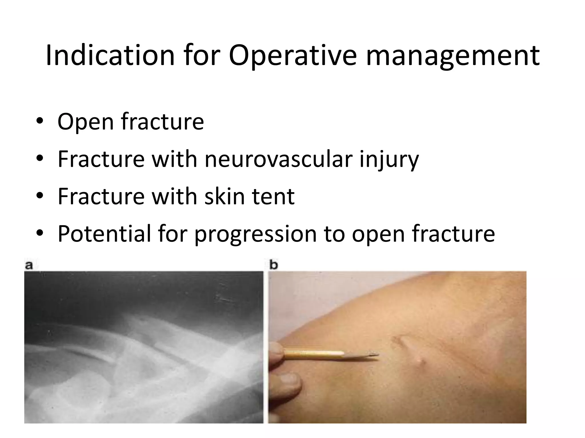 Clavicle fracture & injuries around shoulder | PPTX