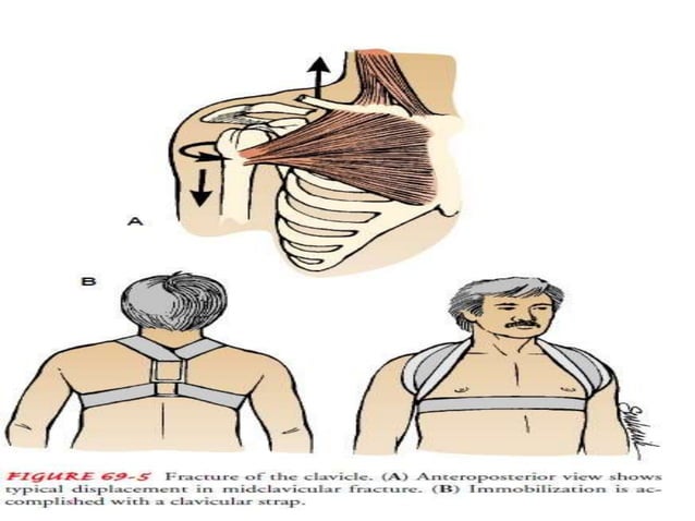 Clavicle fracture & injuries around shoulder | PPTX