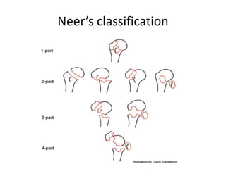Clavicle fracture & injuries around shoulder | PPTX