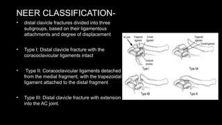 CLAVICLE FRACTURE clinical features and management | PPT