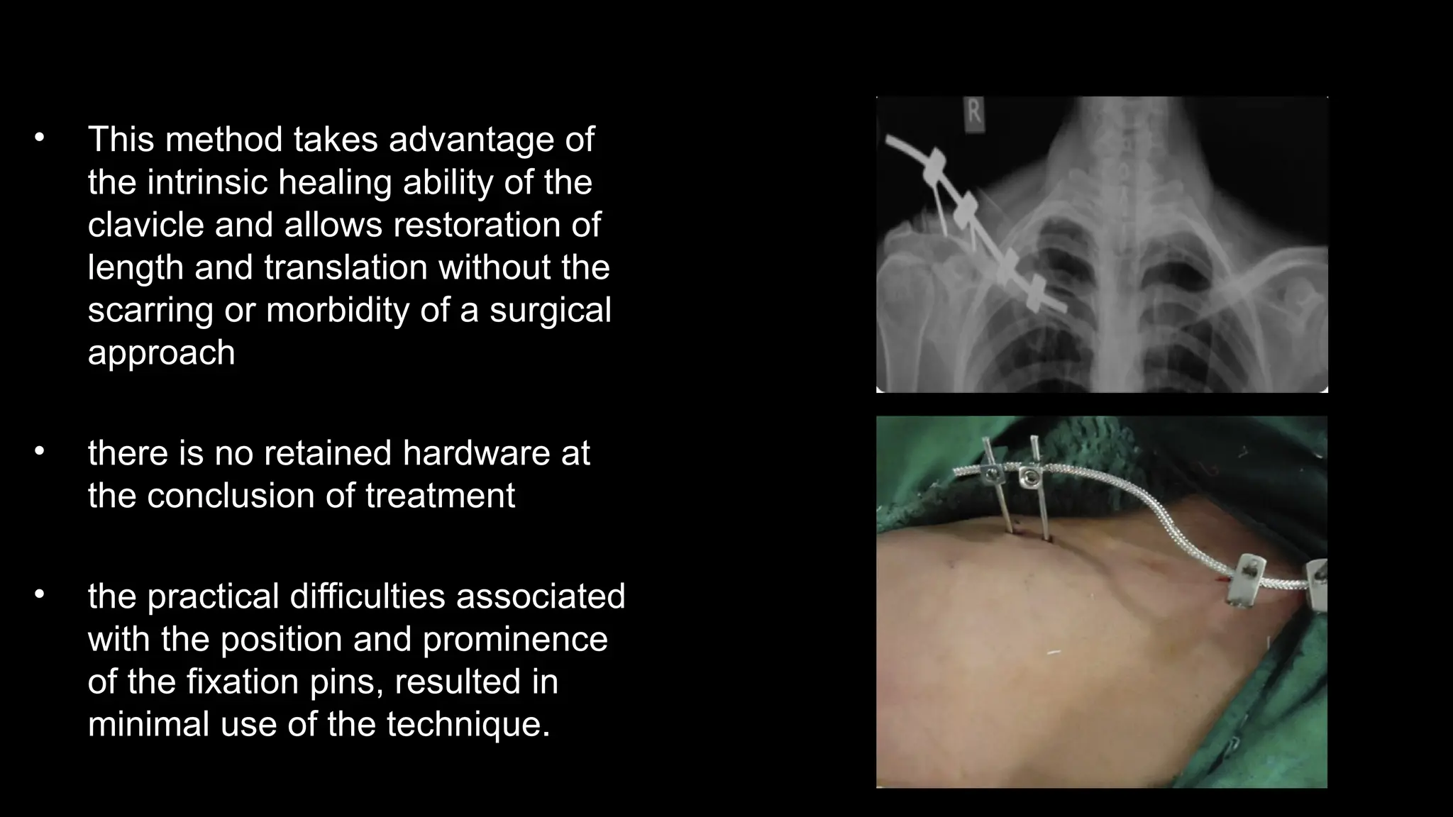 CLAVICLE FRACTURE clinical features and management | PPTX
