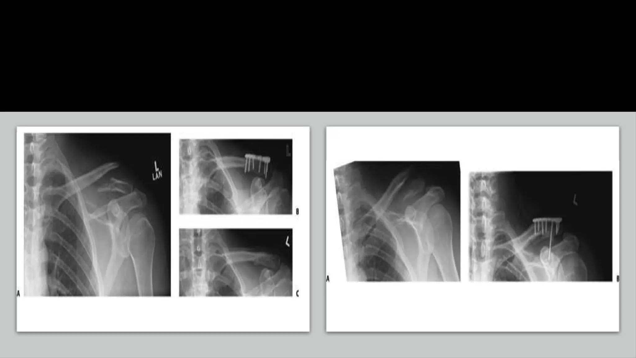 CLAVICLE FRACTURE clinical features and management | PPTX