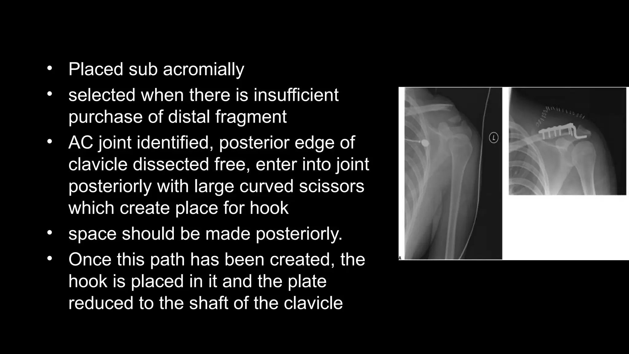 CLAVICLE FRACTURE clinical features and management | PPTX