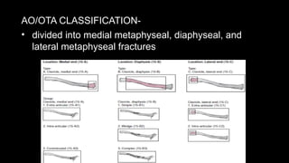 CLAVICLE FRACTURE clinical features and management | PPTX