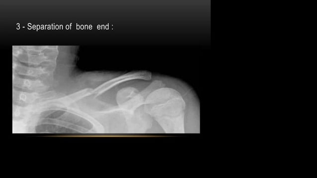 CLAVICLE FRACTURE clinical features and management | PPT