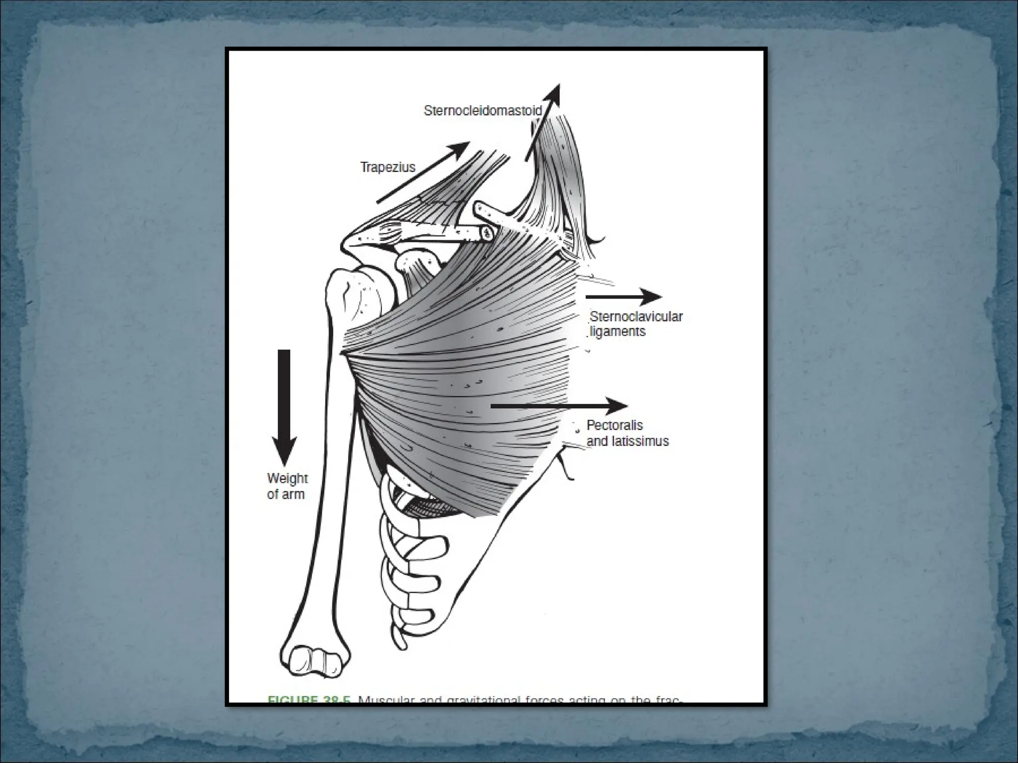CLAVICLE FRACTURE - Etiopathogenesis , clinical features and management.ppt