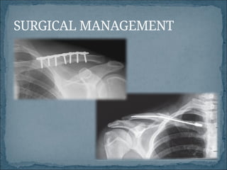 CLAVICLE FRACTURE - Etiopathogenesis , clinical features and management.ppt