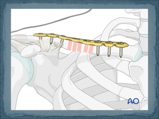 CLAVICLE FRACTURE - Etiopathogenesis , clinical features and management.ppt