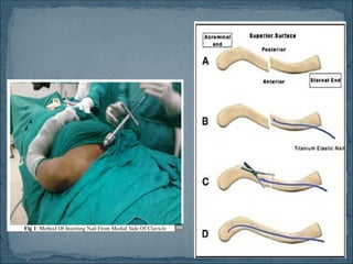 CLAVICLE FRACTURE - Etiopathogenesis , clinical features and management.ppt