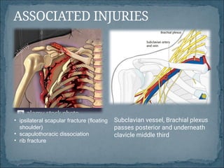 CLAVICLE FRACTURE - Etiopathogenesis , clinical features and management.ppt