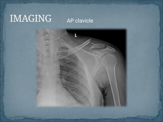 CLAVICLE FRACTURE - Etiopathogenesis , clinical features and management.ppt