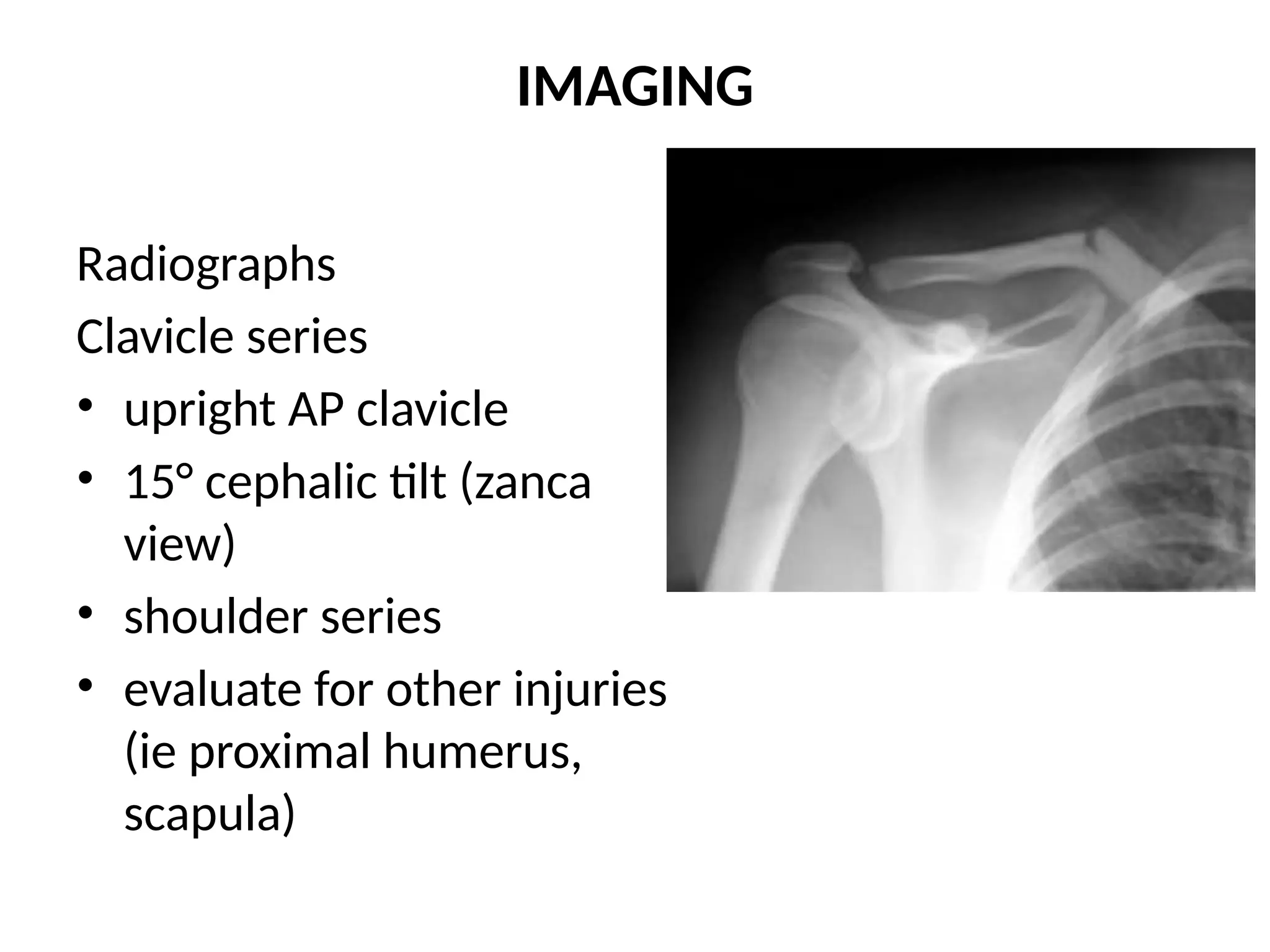 Clavicle Fracture cause management and treatment.pptx