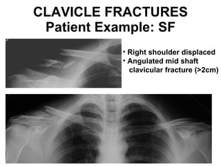 Clavicle fractures | PPT