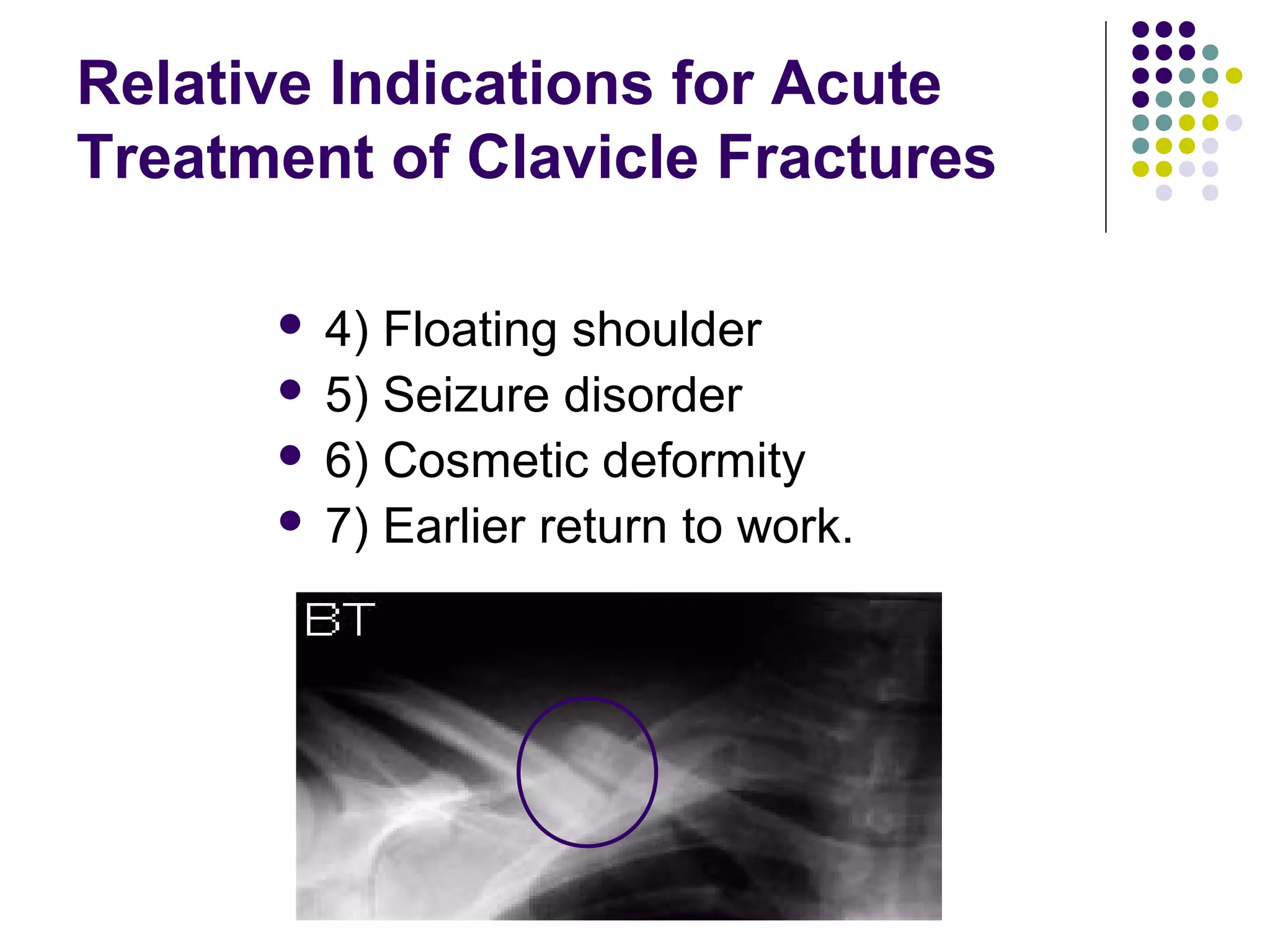 Clavicle fractures | PPT