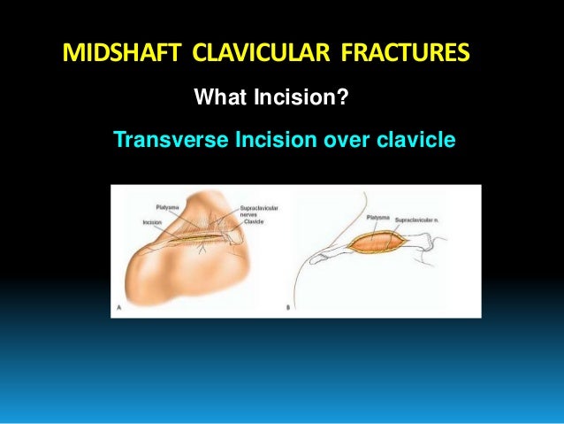 Clavicle fractures