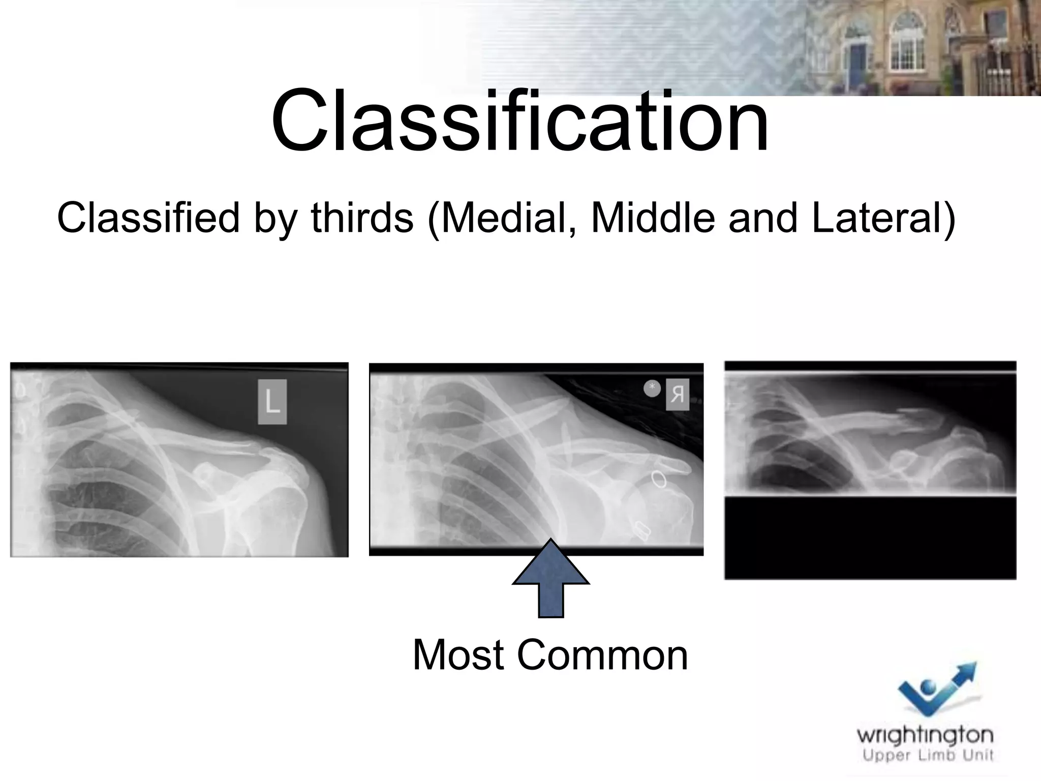 Clavicle fractures | PPTX