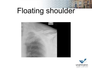Clavicle fractures | PPTX