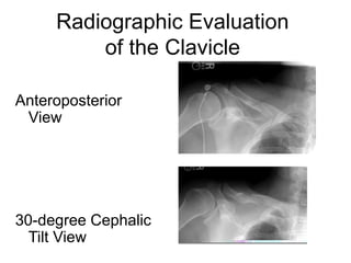 Clavicle fractures | PPTX