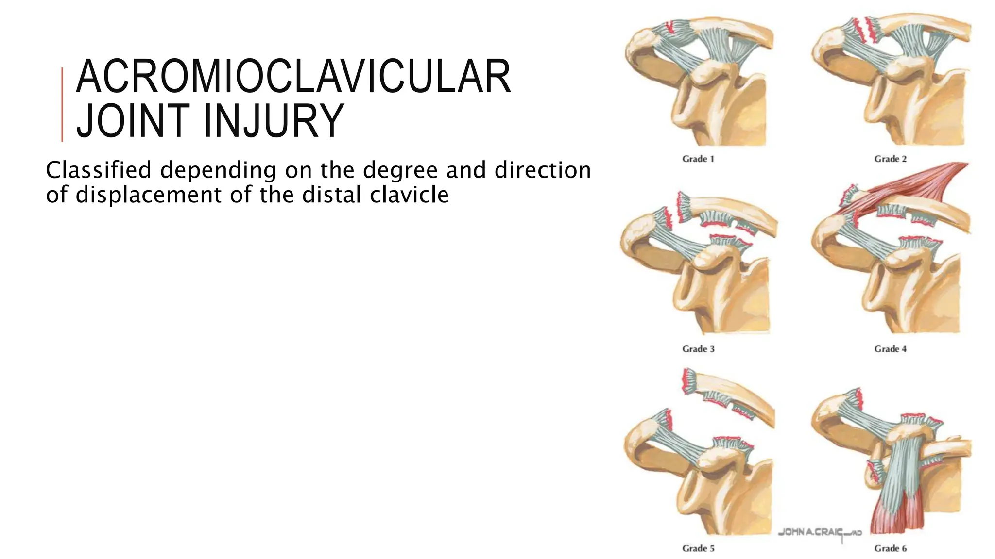 Clavicle fractures (Fraktur Pada Clavicula) | PPTX