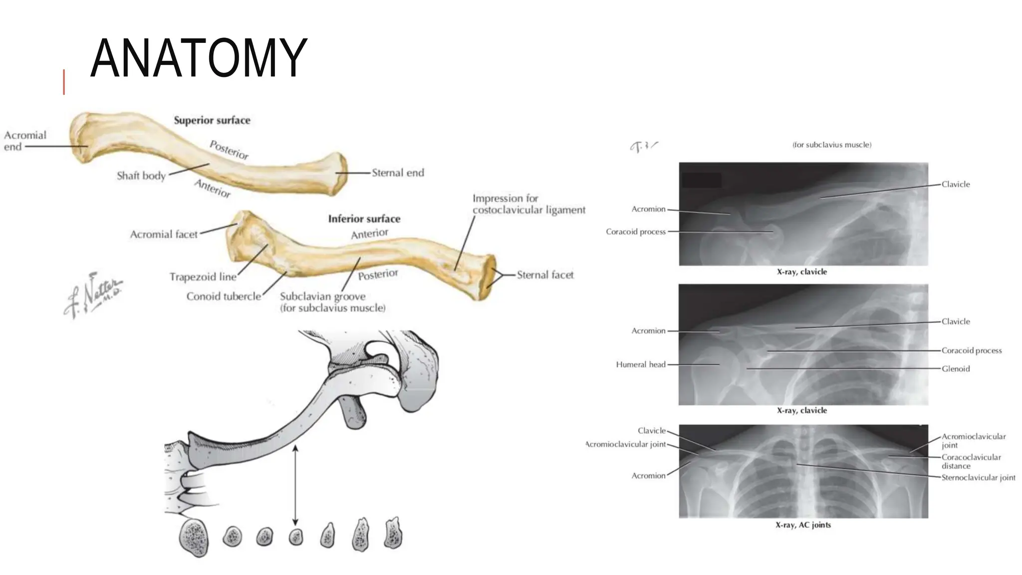 Clavicle fractures (Fraktur Pada Clavicula) | PPTX