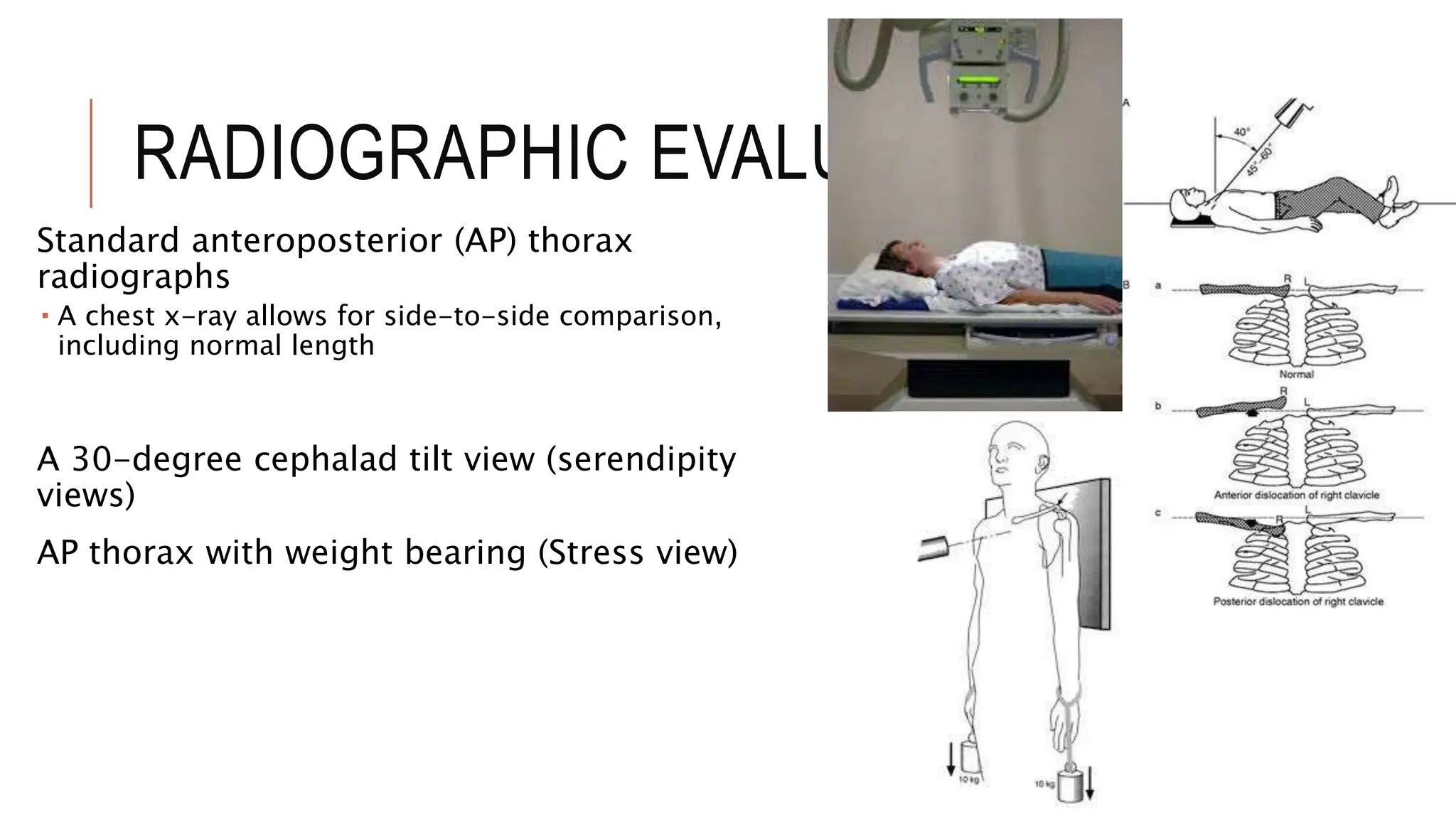 Clavicle fractures (Fraktur Pada Clavicula) | PPTX
