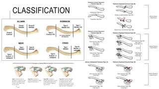 Clavicle fractures (Fraktur Pada Clavicula) | PPTX