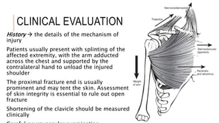 Clavicle fractures (Fraktur Pada Clavicula) | PPTX