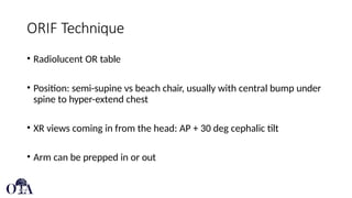 Clavicle Fractures clavicle fracture clavicle | PPTX