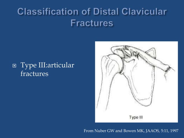 Clavicle fractures&acromio clavicular joint injuries | PPTX | Death ...