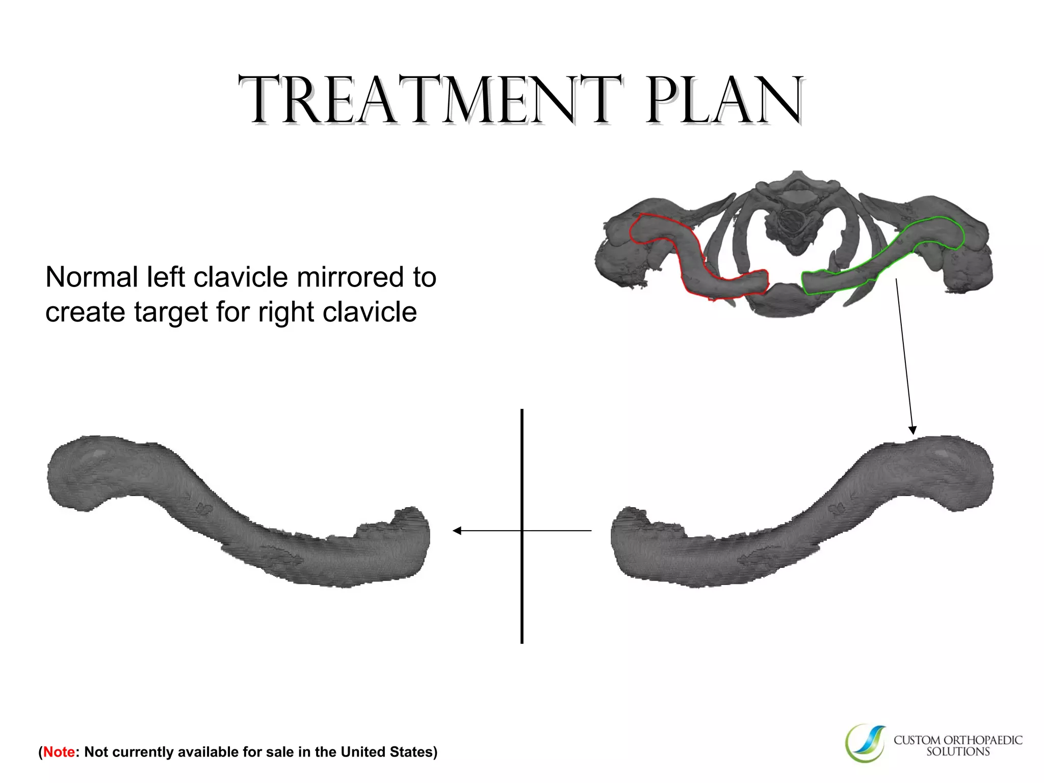 Clavicle malunion compact | PPT