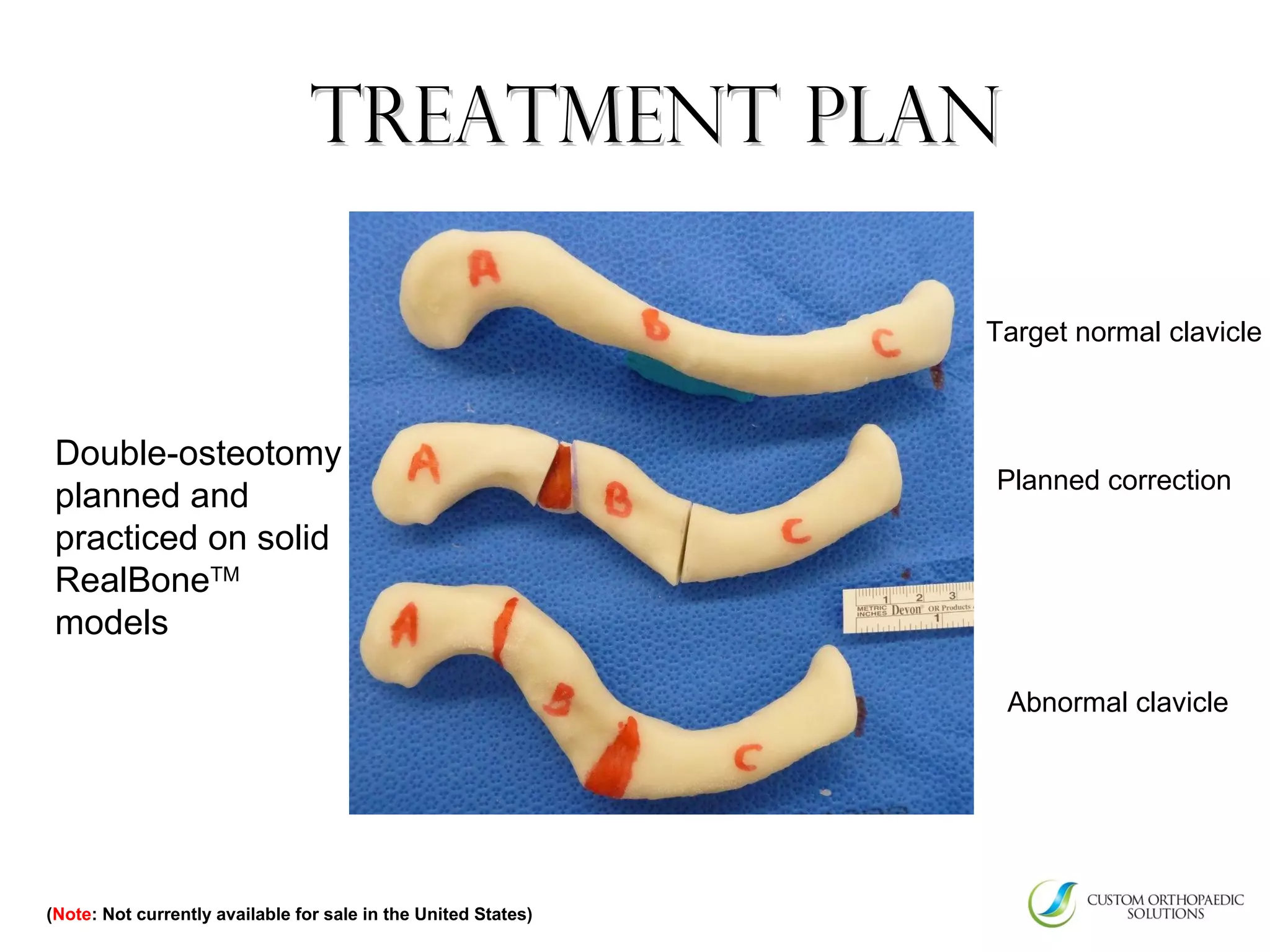 Clavicle malunion compact | PPT