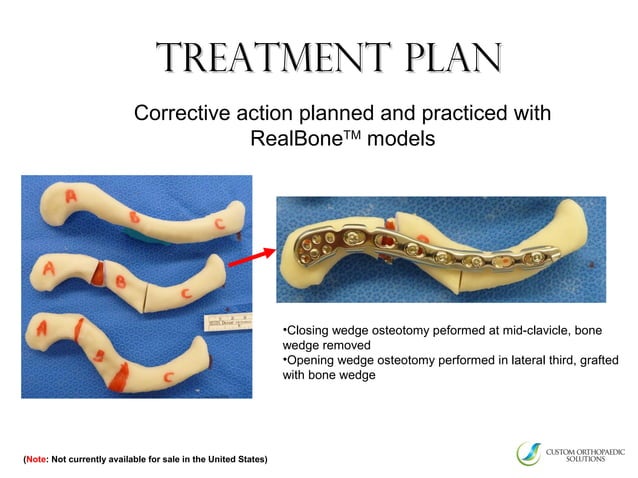 Clavicle malunion compact | PPT
